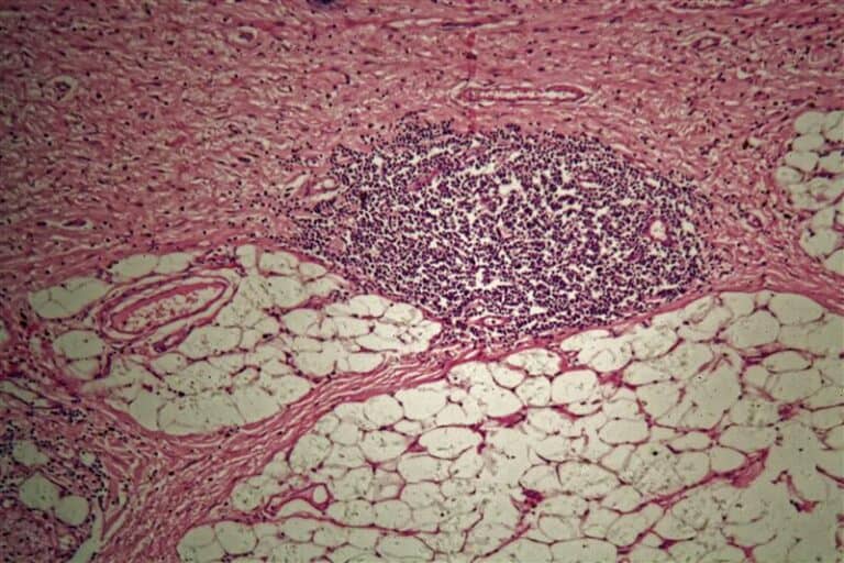 Why Do We Get Cancer? How Our Lifestyles Impact Our Risk - Cancer ...